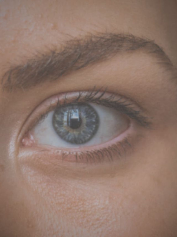 Blepharitis | Symptoms, Causes, Treatment & More & MTHK